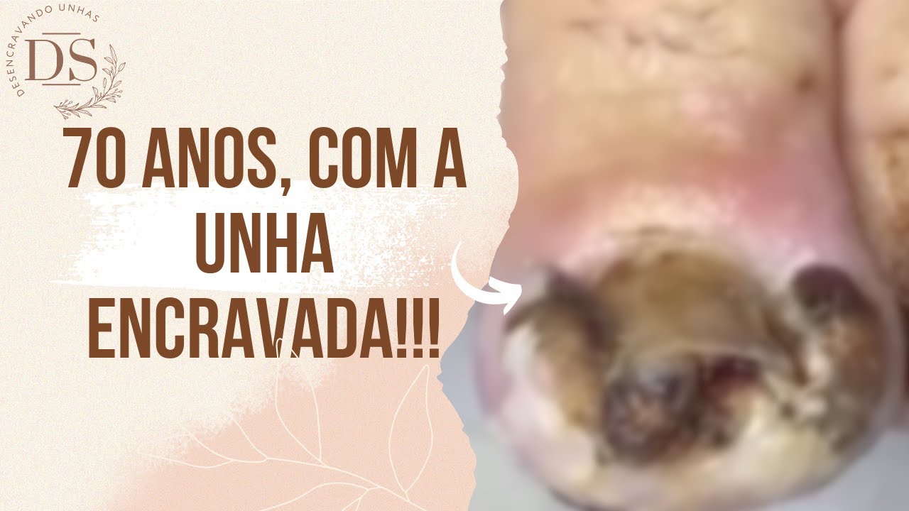 Unha encravada satisfatório - caso extremo, ela tem 70 anos, com a unha ...