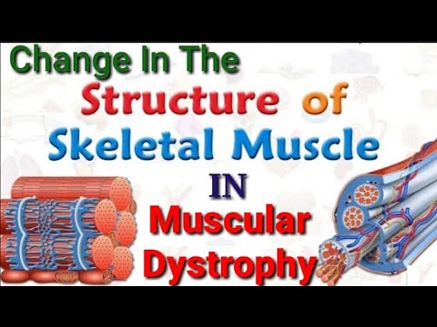 Effect on muscular strength in muscular dystrophy ! muscle structure ...