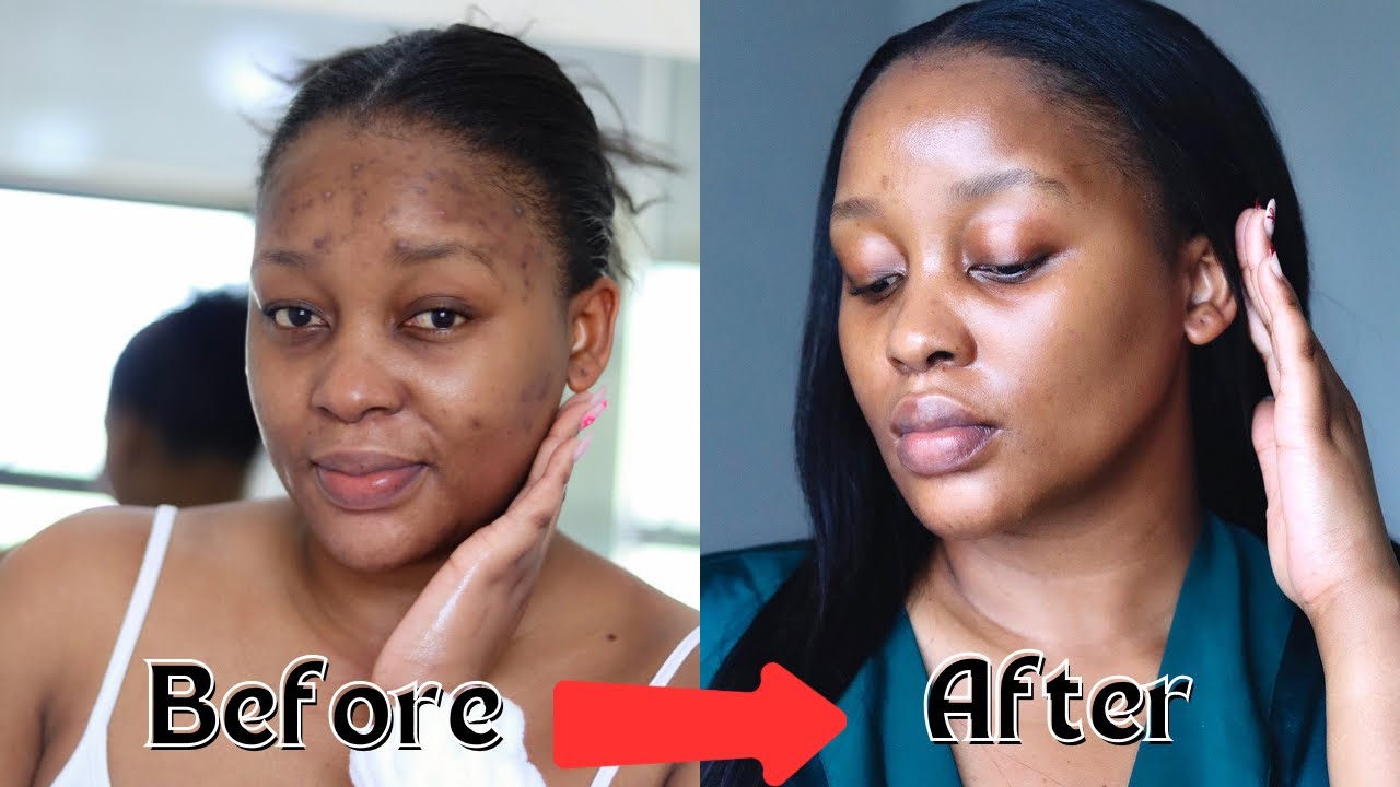SKINCARE made simple | How I got rid of my acne + dark spots ...
