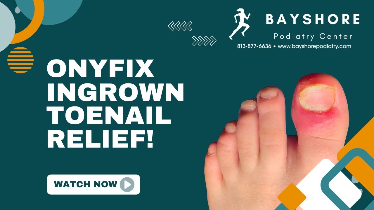 A Painless, Surgery-Free Fix for Ingrown Toenails! - YouTube