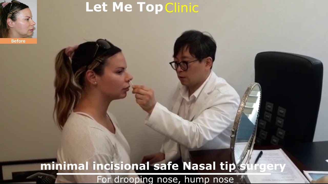 minimal incisional safe nasal tip surgery for drooping nose, hump nose ...