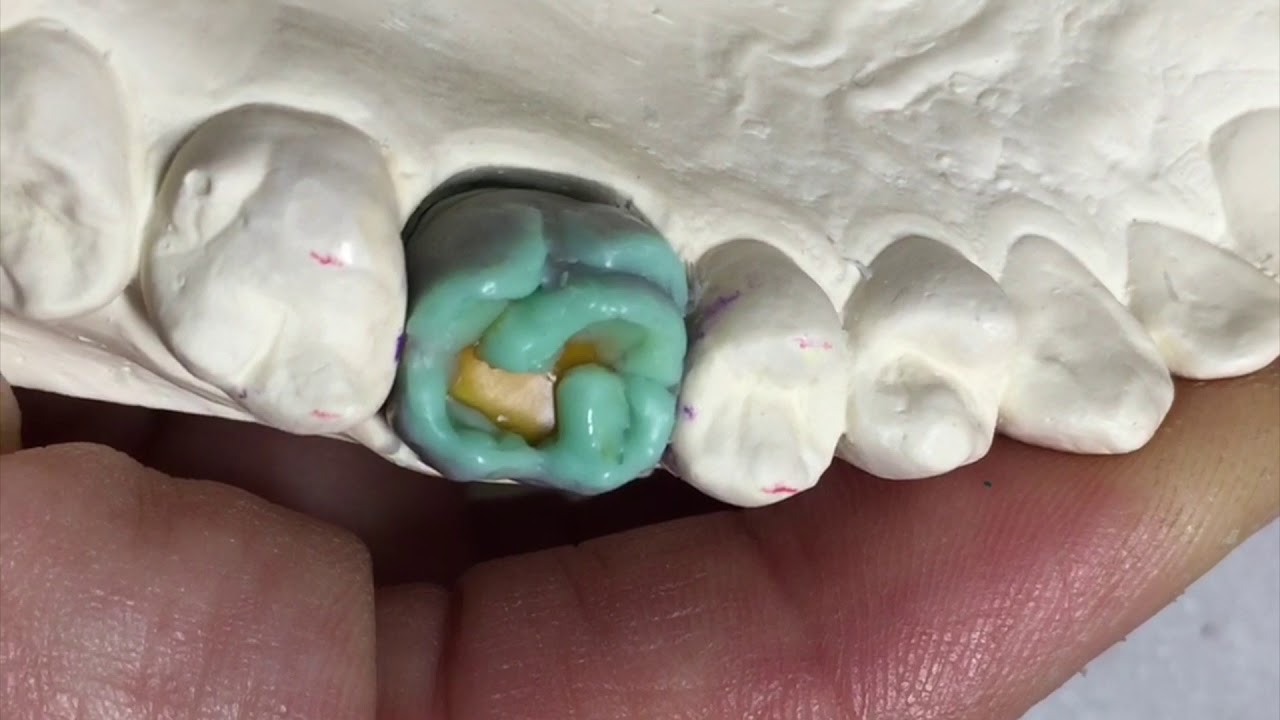 CGC - Modelage de la surface occlusale d'une molaire maxillaire - YouTube