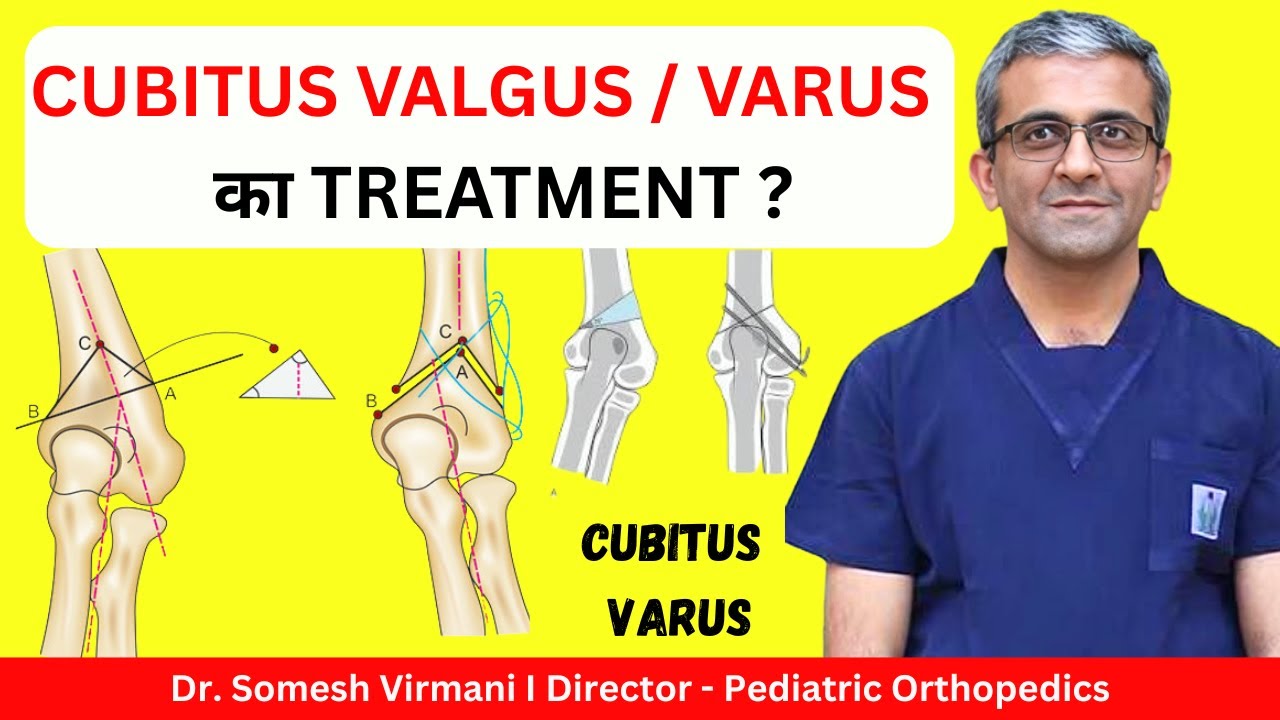Cubitus Varus: कब ज़रूरी होती है Surgery? | Cubitus Valgus Difference ...