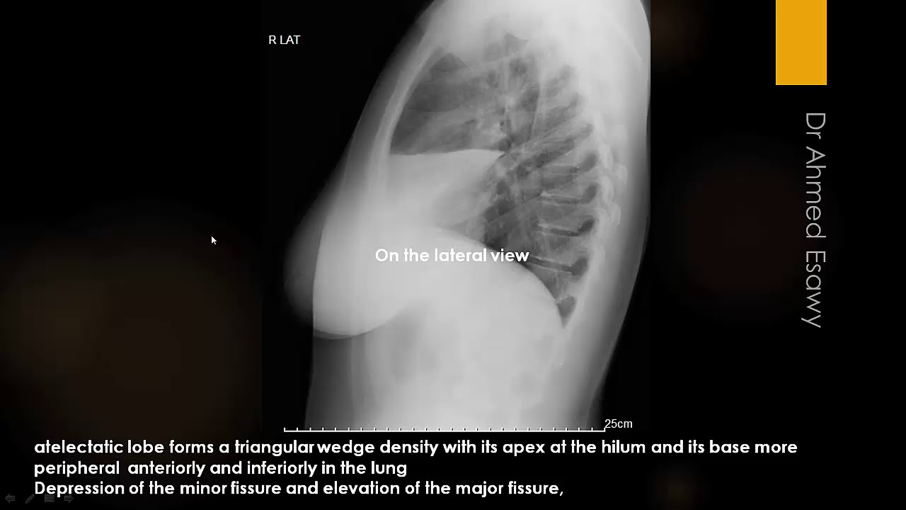 Right Middle Lobe Syndrome - YouTube