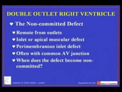 Double outlet right ventricle (DORV) - YouTube