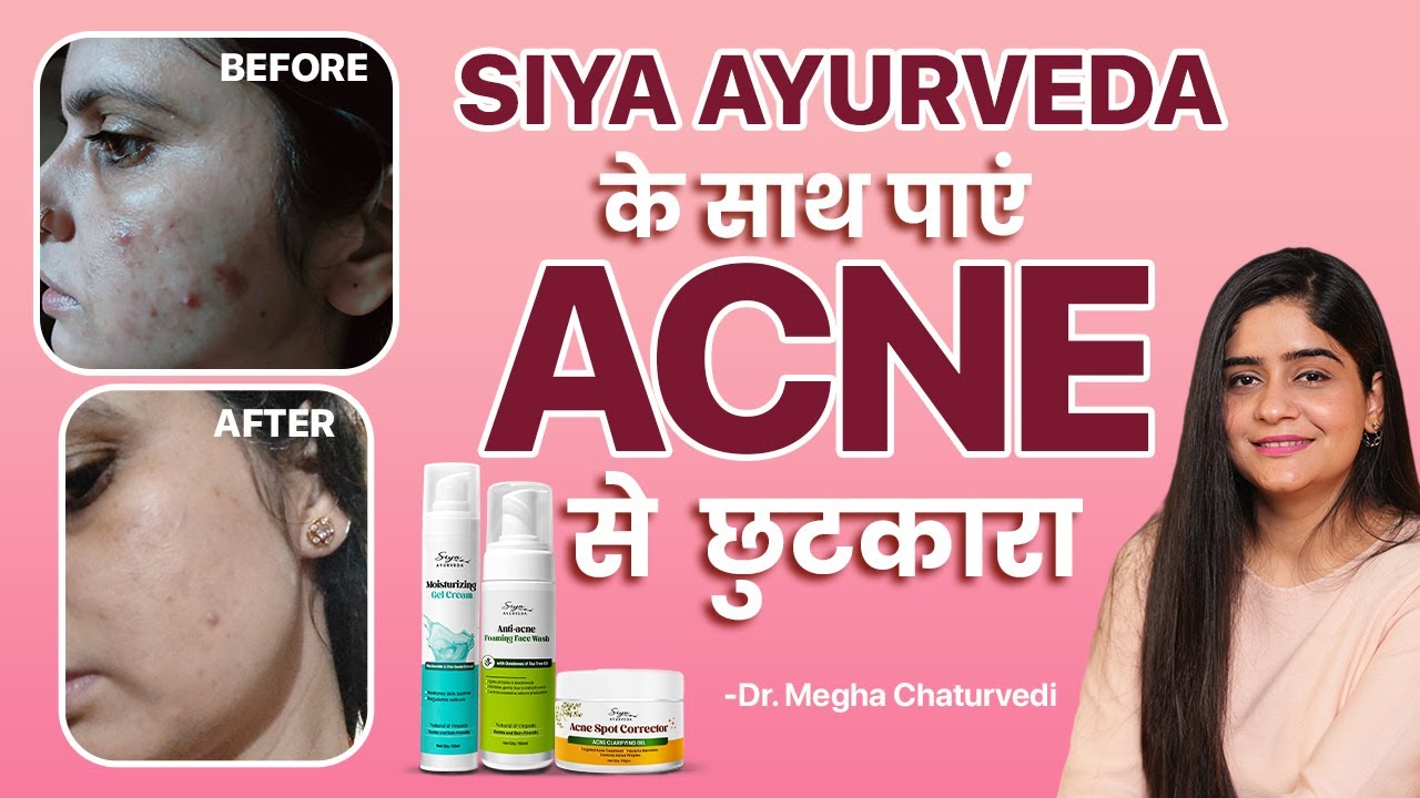 Best Acne Treatment with Siya | How to Treat Acne Naturally - YouTube