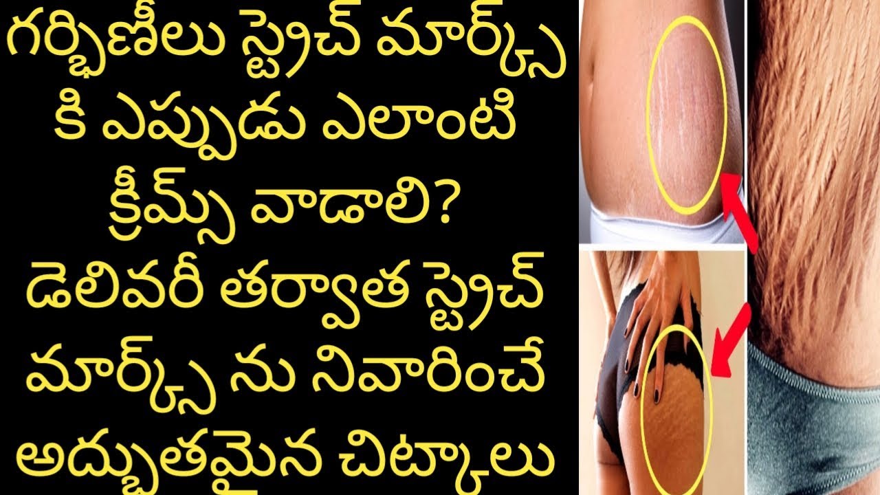 Easy and quick way to prevent stretch marks|Excellent tips to prevent ...