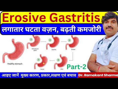 Understanding Erosive Gastritis: Causes, Symptoms, and Management ...