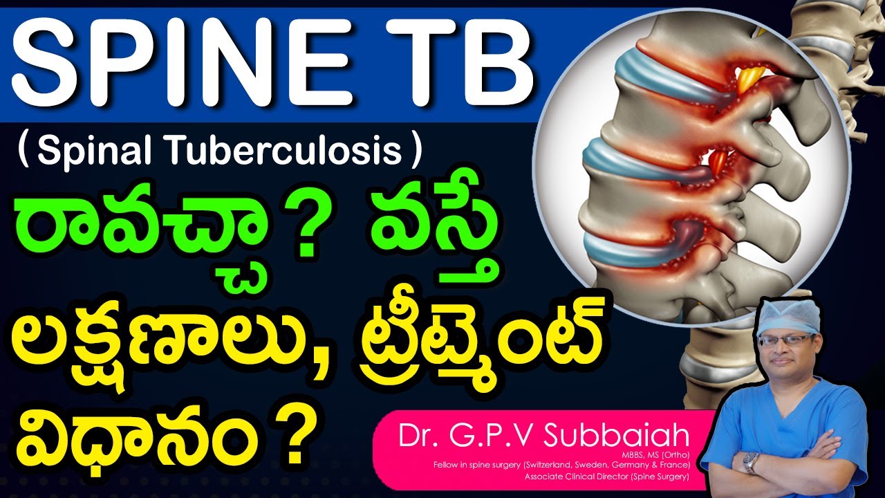 Spinal Tuberculosis (SPINE TB) Causes , Symptoms & treatment I ...