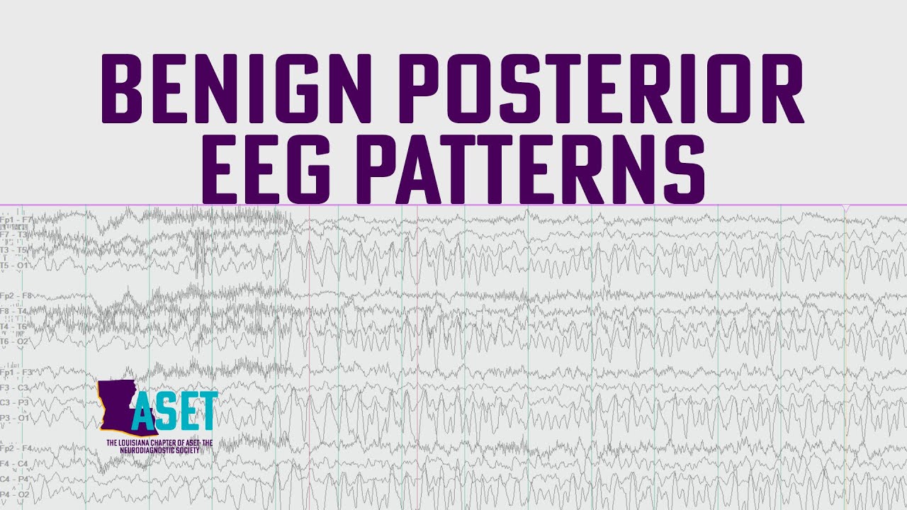 Benign Posterior EEG Patterns - YouTube