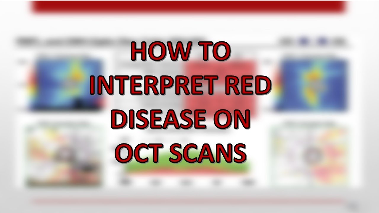 How to interpret OCT scans and red disease // #OCT #analyzingscans # ...