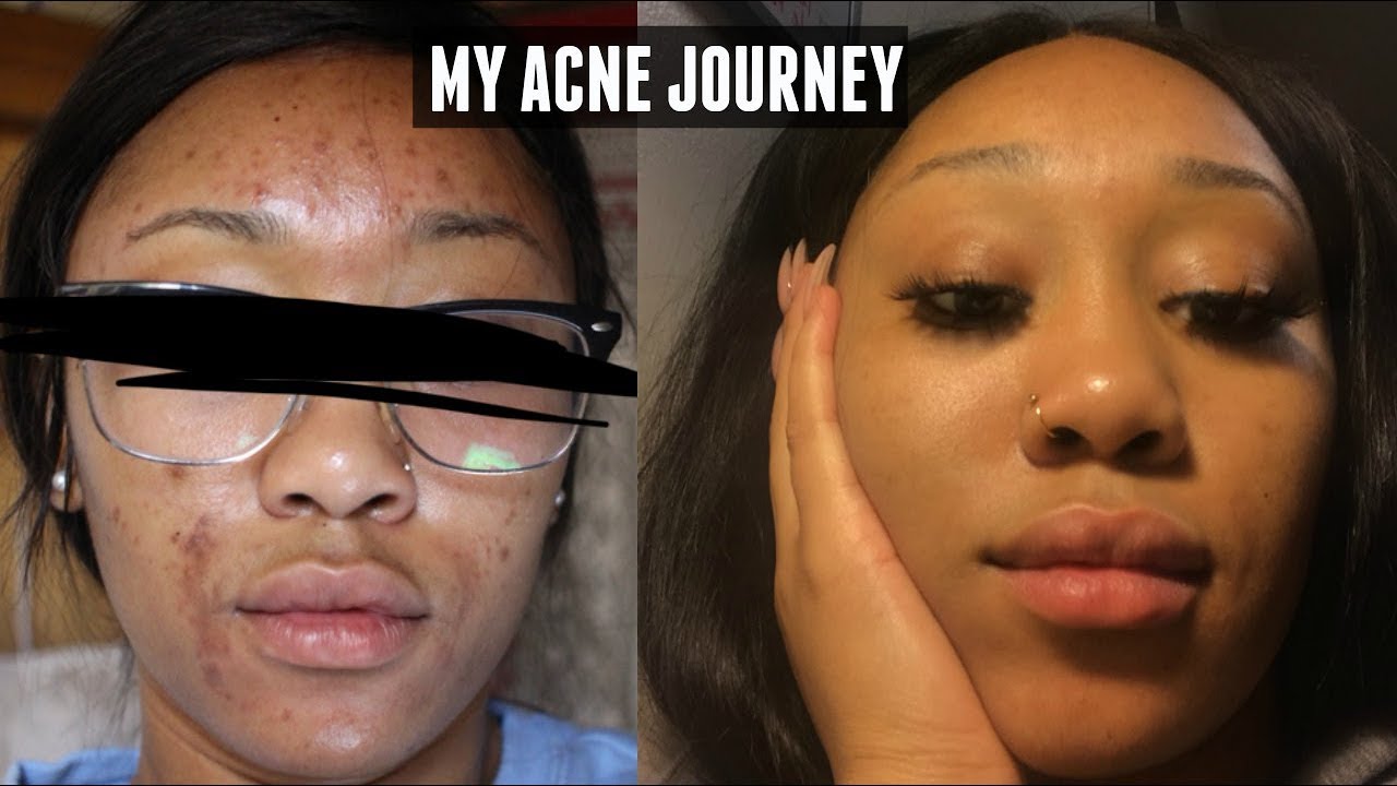 Accutane Before And After African American