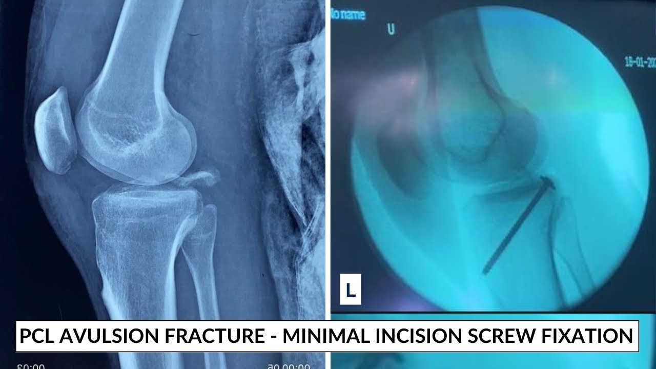 PCL AVULSION FRACTURE - minimal incision Screw Fixation # ...