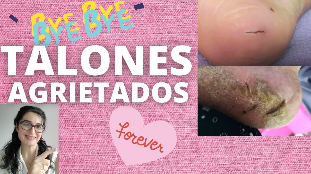 TALONES AGRIETADOS con FISURAS Sigue este TRATAMIENTO y PREVIENE para ...
