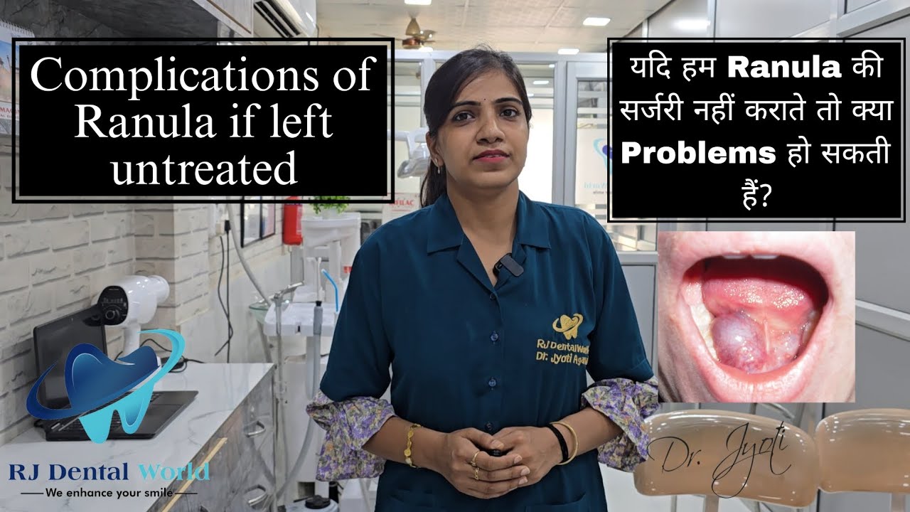 Ranula Agar Untreated Chhod Di To Kya Hoga? | Ranula Surgery Zaruri Kyu ...