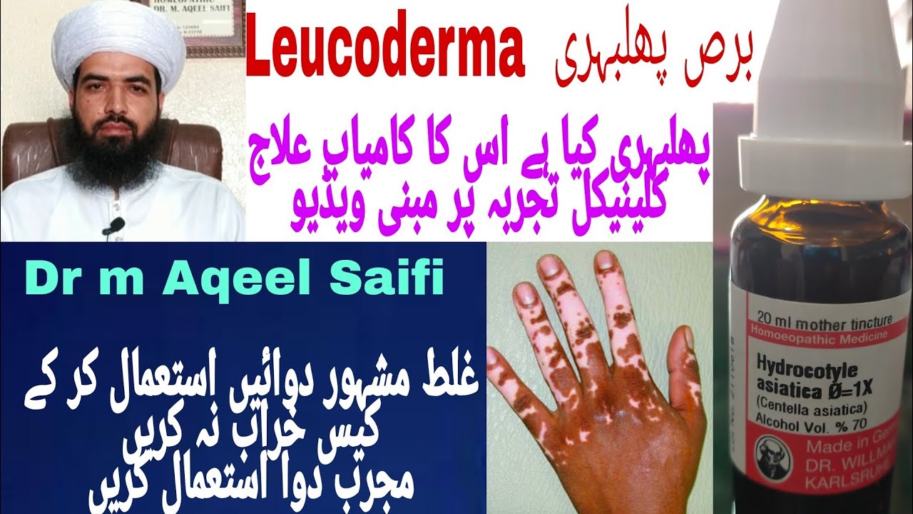 Leucoderma treatment by homeopathic medicine پھلبہری کا کامیاب علاج ...