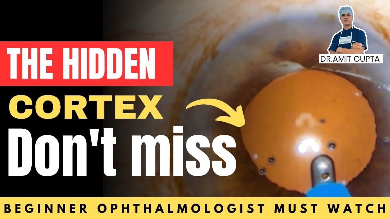 Hidden Cortex in Phaco : A lesson to Beginners Ophthalmologist - YouTube