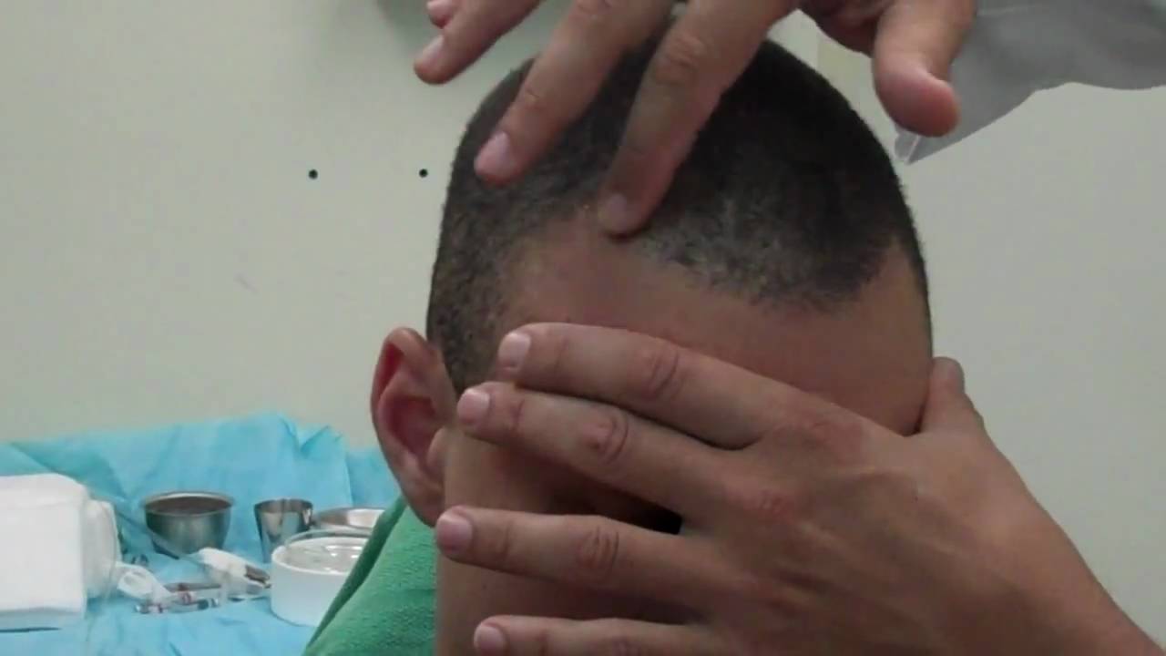 Plastic surgeon Dr. Jeffrey Epstein does FUE hair transplant - YouTube