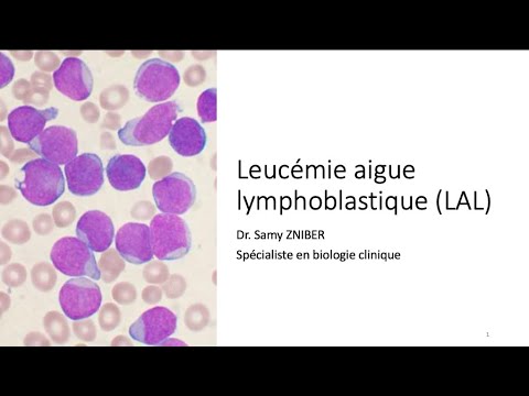 Leucémie aigue lymphoblastique (LAL) - Dr. Samy Zniber - YouTube