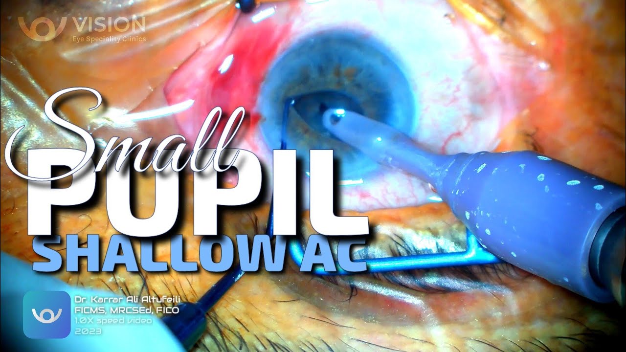 Cataract surgery ( phacoemulsification ) in small pupil, shallow AC ...