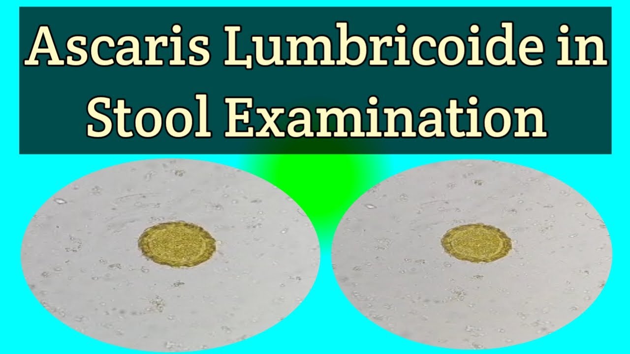 Ascaris Lumbricoides | Parasite in Stool Microscope | Stool Examination ...