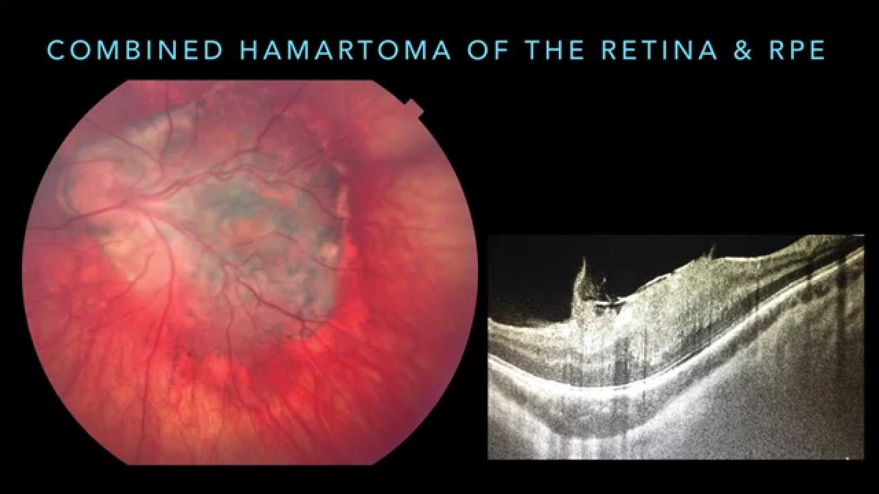 Intraocular Tumors 101 - YouTube