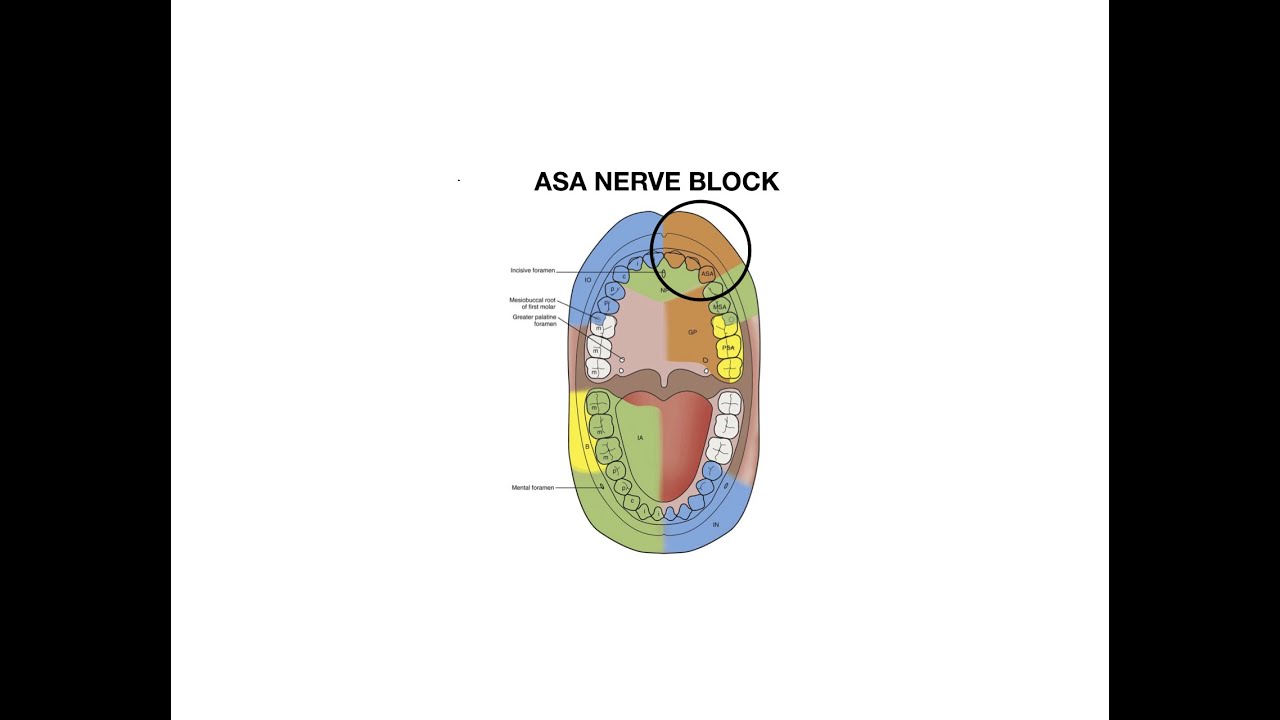 Anterior Superior Alveolar Nerve Block Injection - YouTube