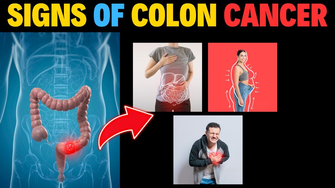 10 Early Signs of Colon Cancer - YouTube