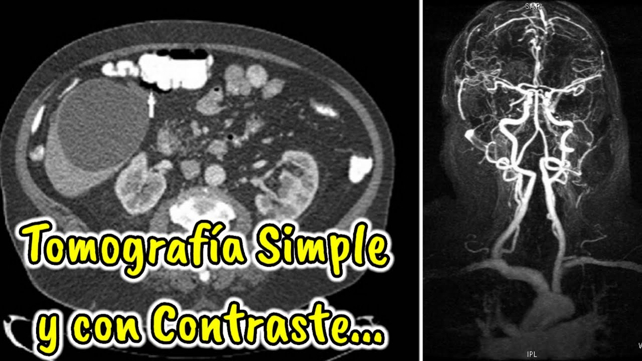 Tomografía simple y con medio de Contraste ☢ - YouTube