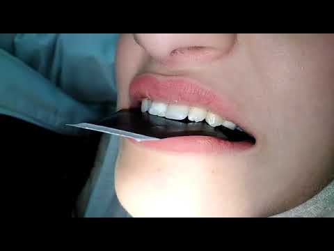 Visit 5: Checking the Acrylic partial denture's clasp relations to the ...