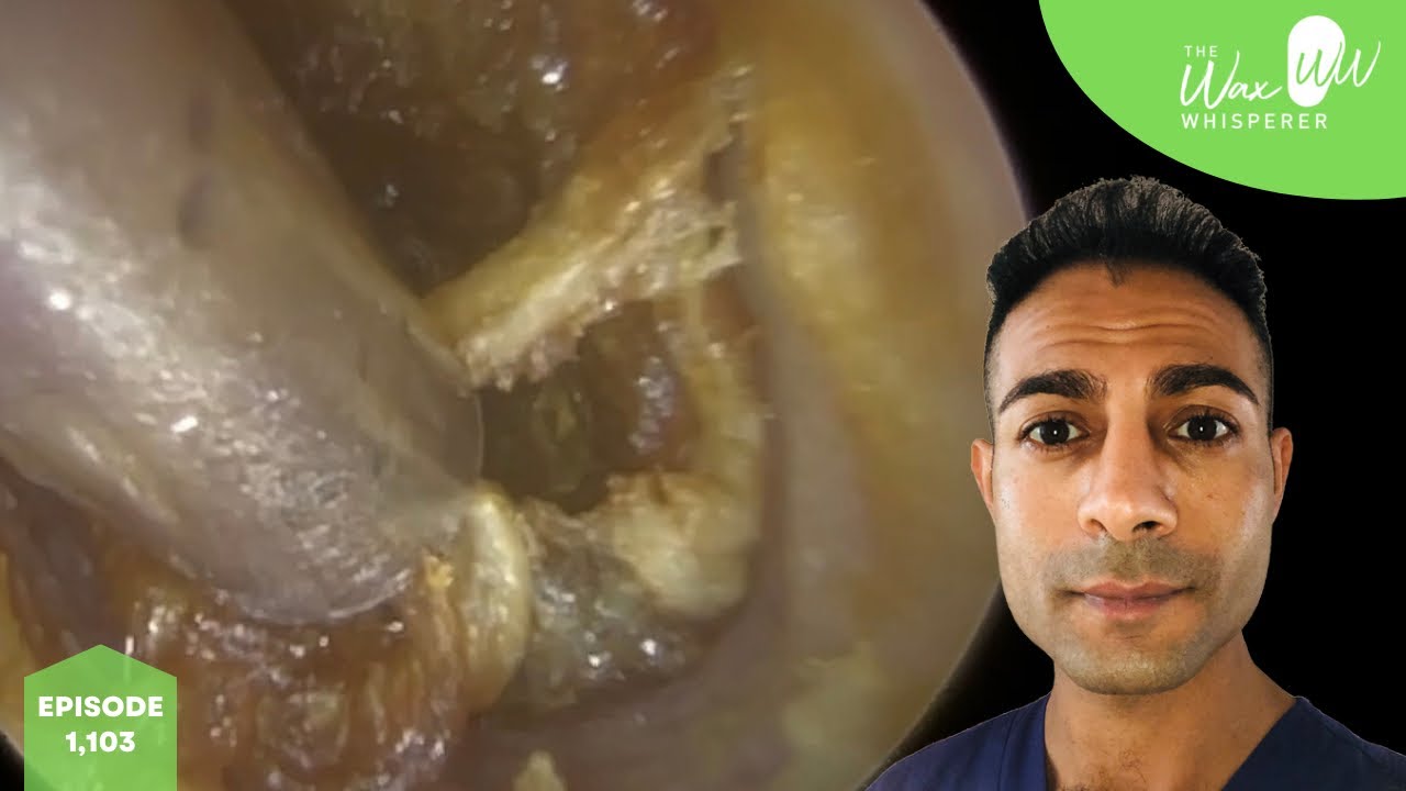 1,103 - Deeply Pushed In Ear Wax Removal - YouTube