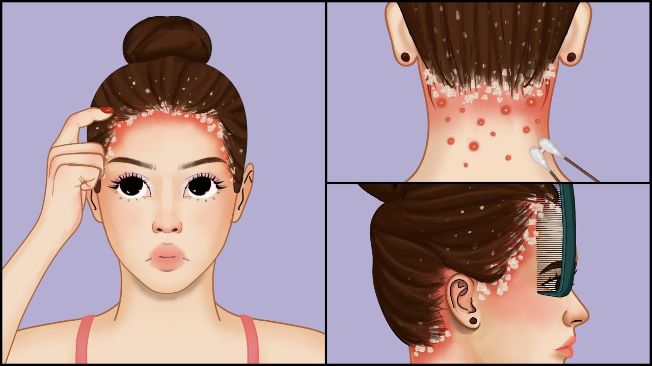 ASMR animation | Big Flakes Dandruff & pimple popping I Satisfying ...