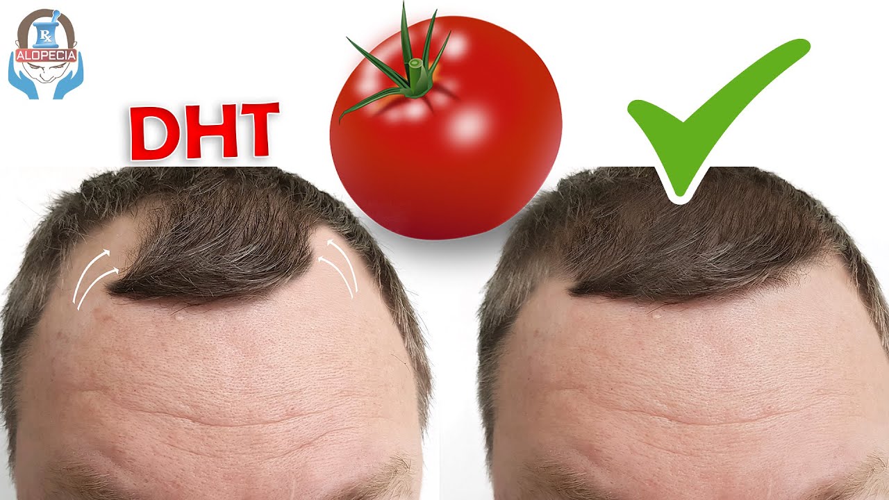 REVERSE HAIR LOSS NATURALLY BY BLOCKING DHT IN SCALP | HAIR LOSS ...