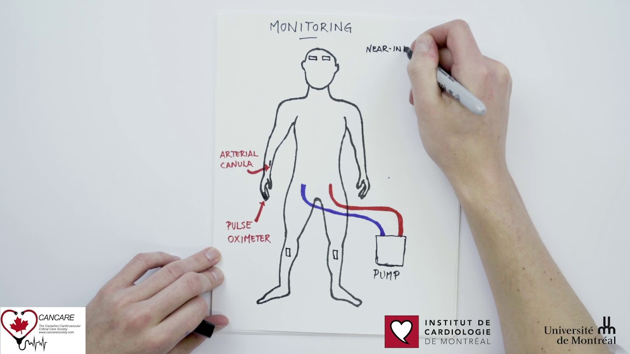 Differential Hypoxemia Veno-Arterial ECMO - YouTube