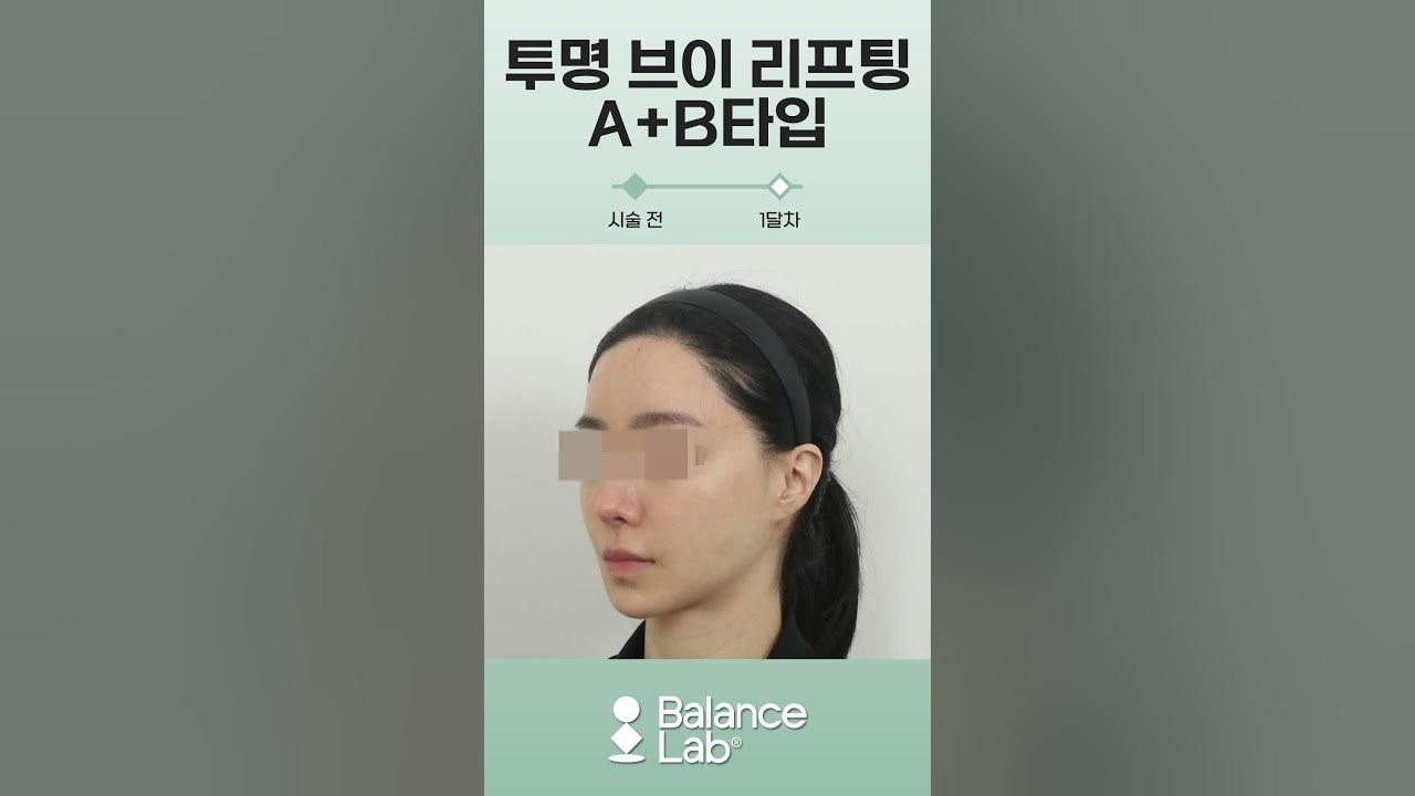 투명브이리프팅 Ab타입 1달차♥️ Shorts 윤곽후처짐 실리프팅 실리프팅후기 실리프팅전후 리프팅 투명브이리프팅