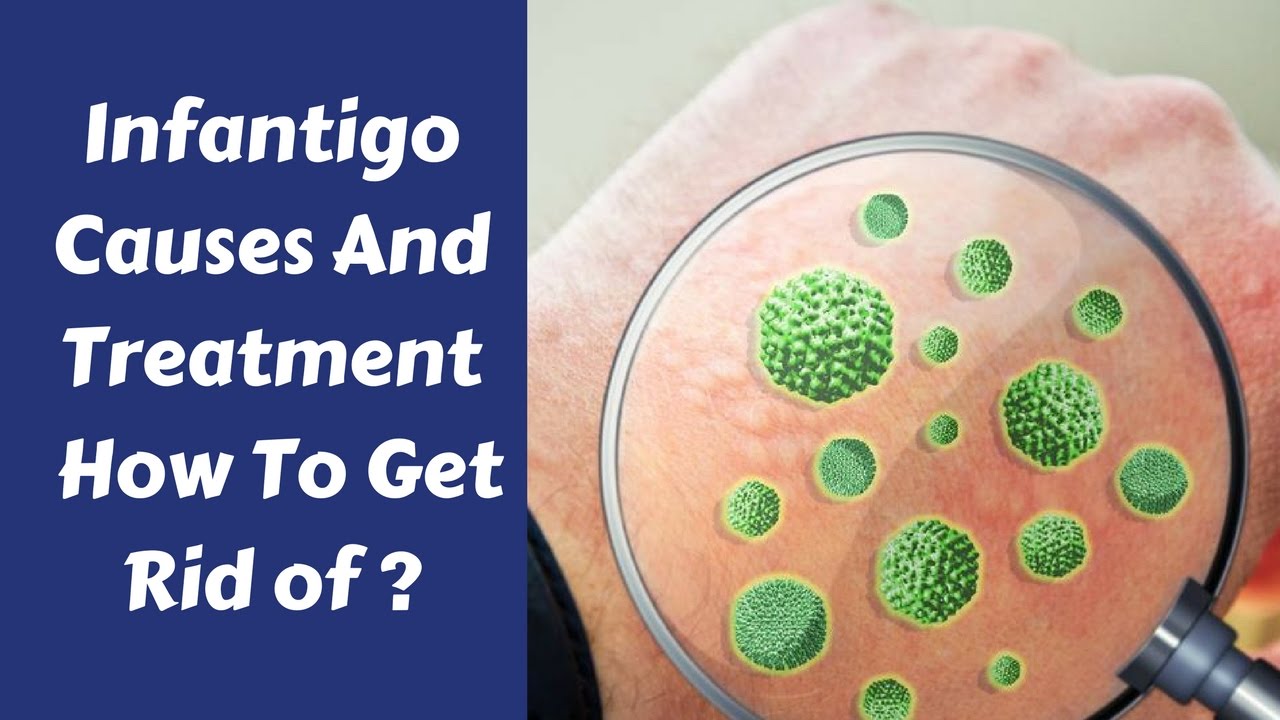 Infantigo Causes And Treatment - How To Get Rid of Impetigo - YouTube