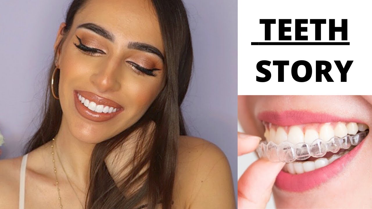 MY INVISALIGN STORY & ΛΕΥΚΑΝΣΗ ΣΤΟ ΣΠΙΤΙ||MARIANNA KALAFATI - YouTube