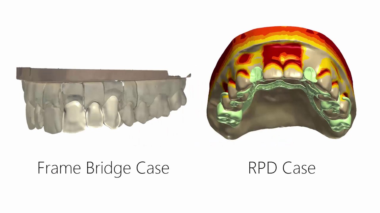 3Shape Dental System - How to Use Facial Cut Back Tool - YouTube