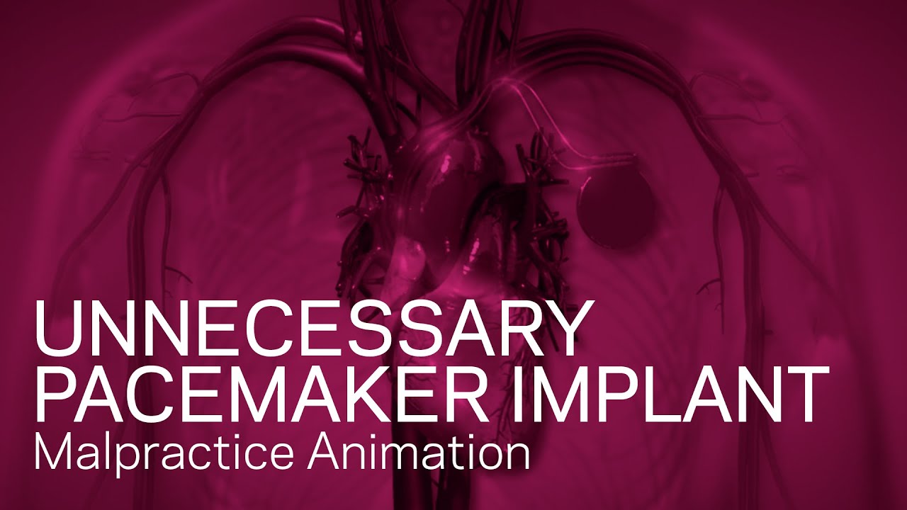 Pacemaker - Medical Device Animation - YouTube
