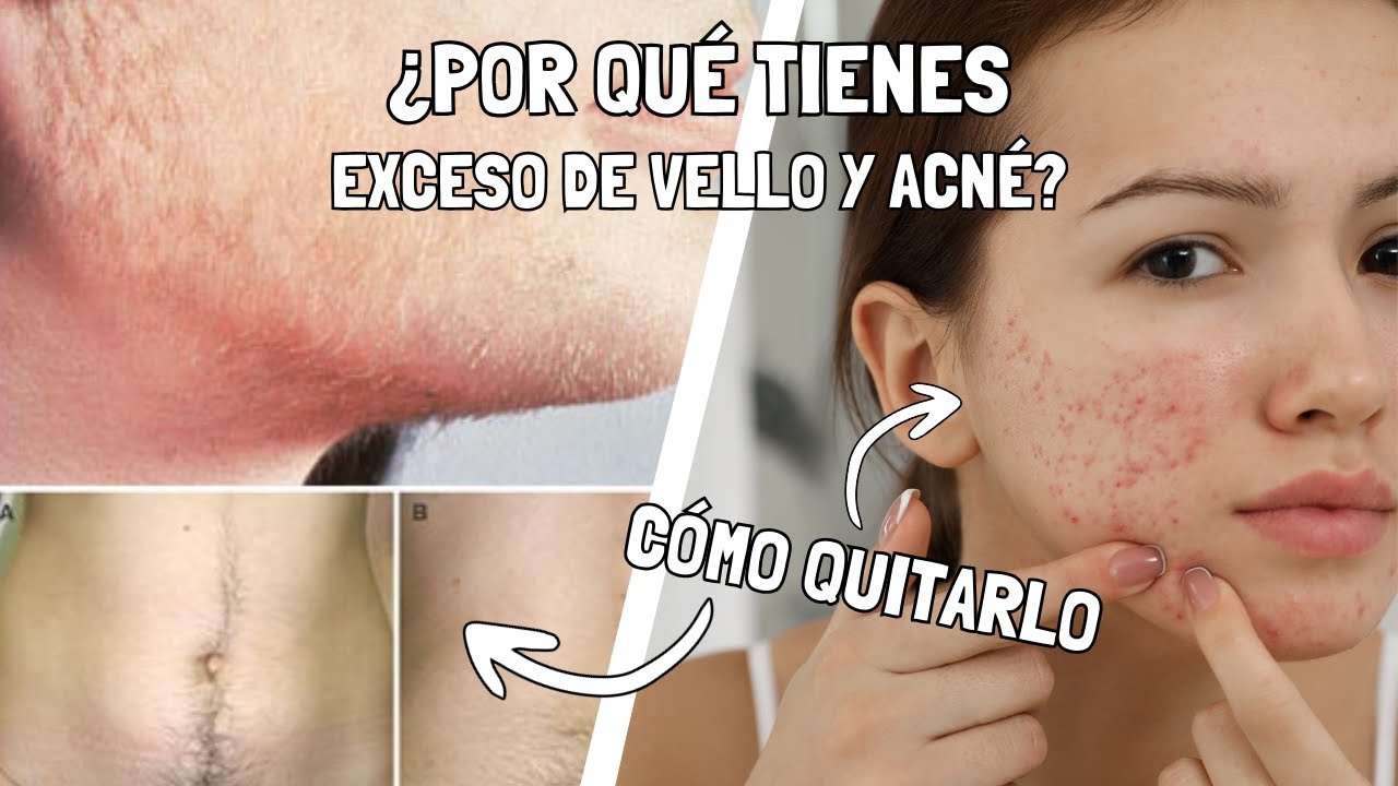 Exceso de vello y Acné por Hiperandrogenismo ¿Cómo tratarlo? - YouTube