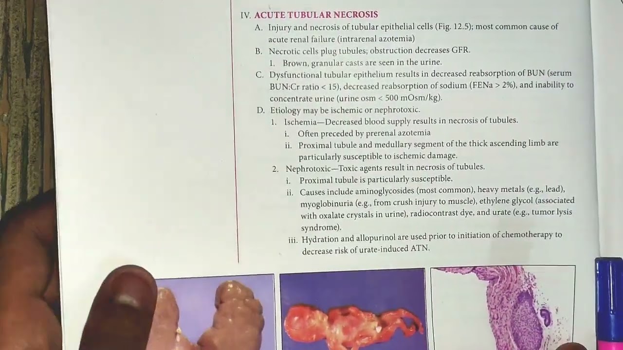 Renal pathology from pathoma part#1 - YouTube