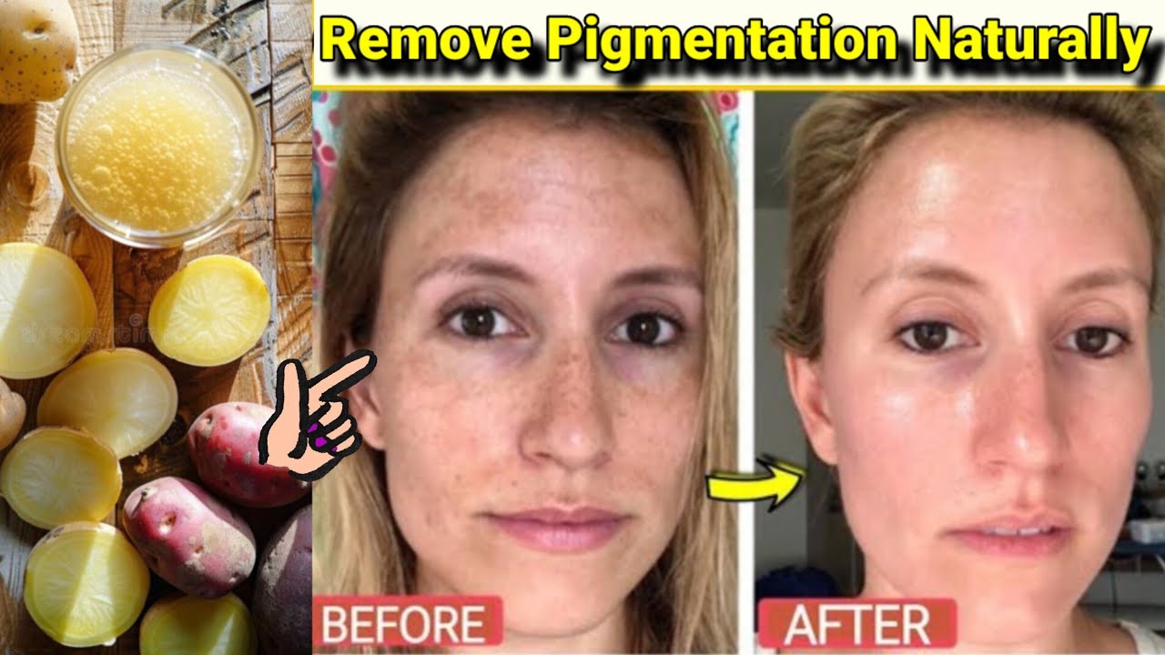 Get Rid Of Pigmentation and Dark Spot Naturally | 2 Step Treatment ...