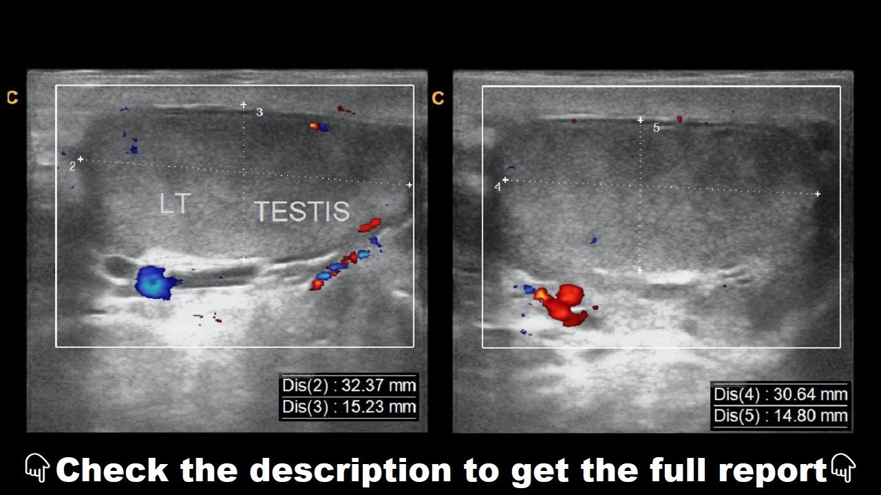 Testicular torsion || Incomplete || Chronic stage || Ultrasound ...