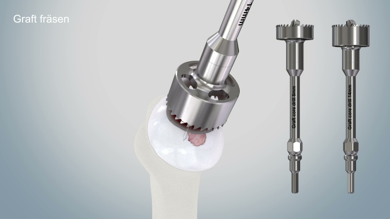 Mathys: Affinis Inverse Bone Grafting Instrumentarium - YouTube