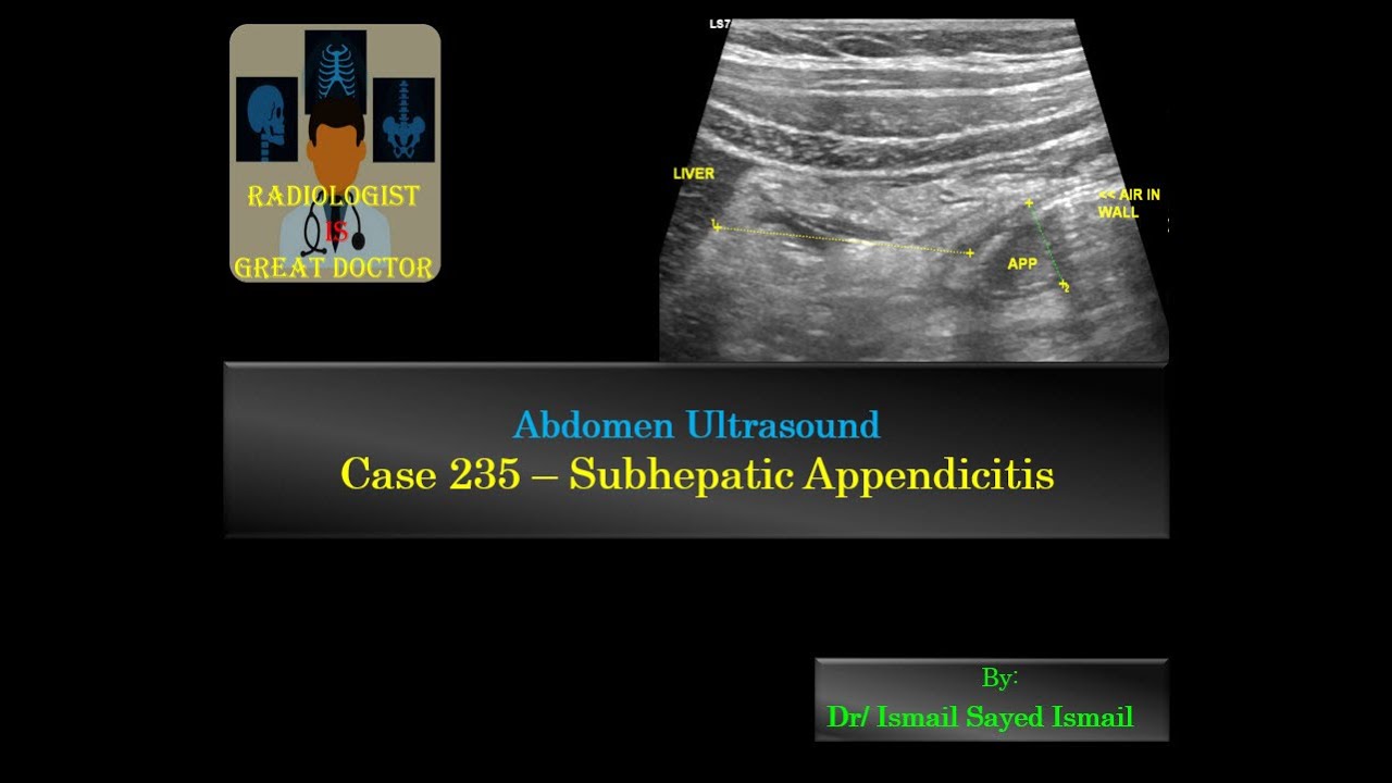 Ultrasound Case 235 - Subhepatic Appendicitis - YouTube