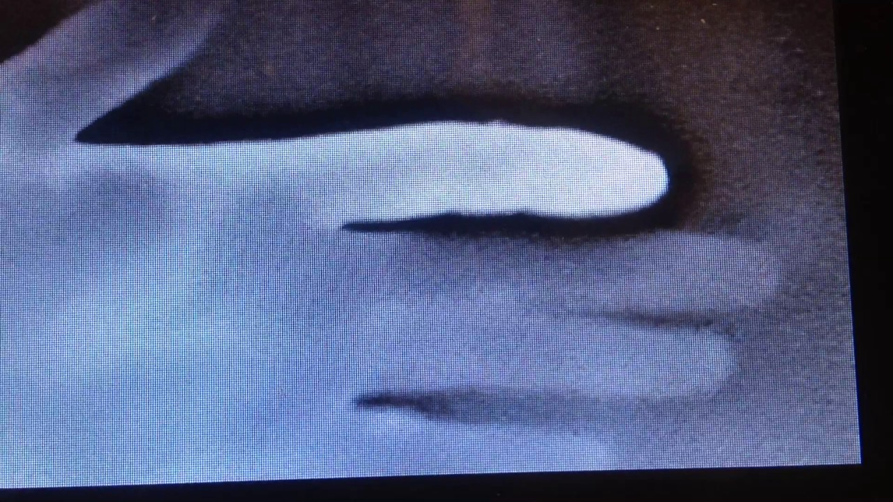 Lacerated finger through thermal camera after stitches - YouTube