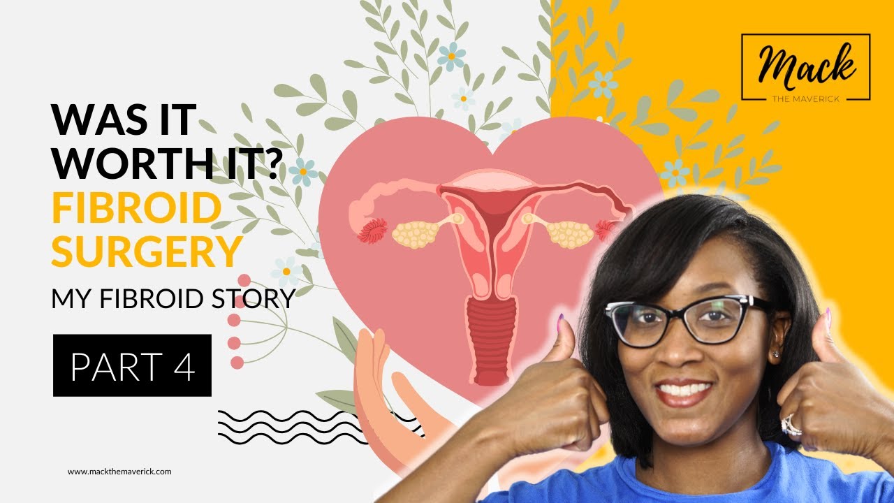 Life After Fibroid Surgery| One Year Open Myomectomy Update - YouTube