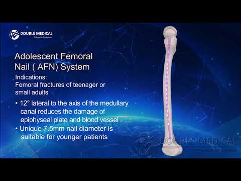 Double Medical Adolescent Femoral Nail (AFN) System - YouTube