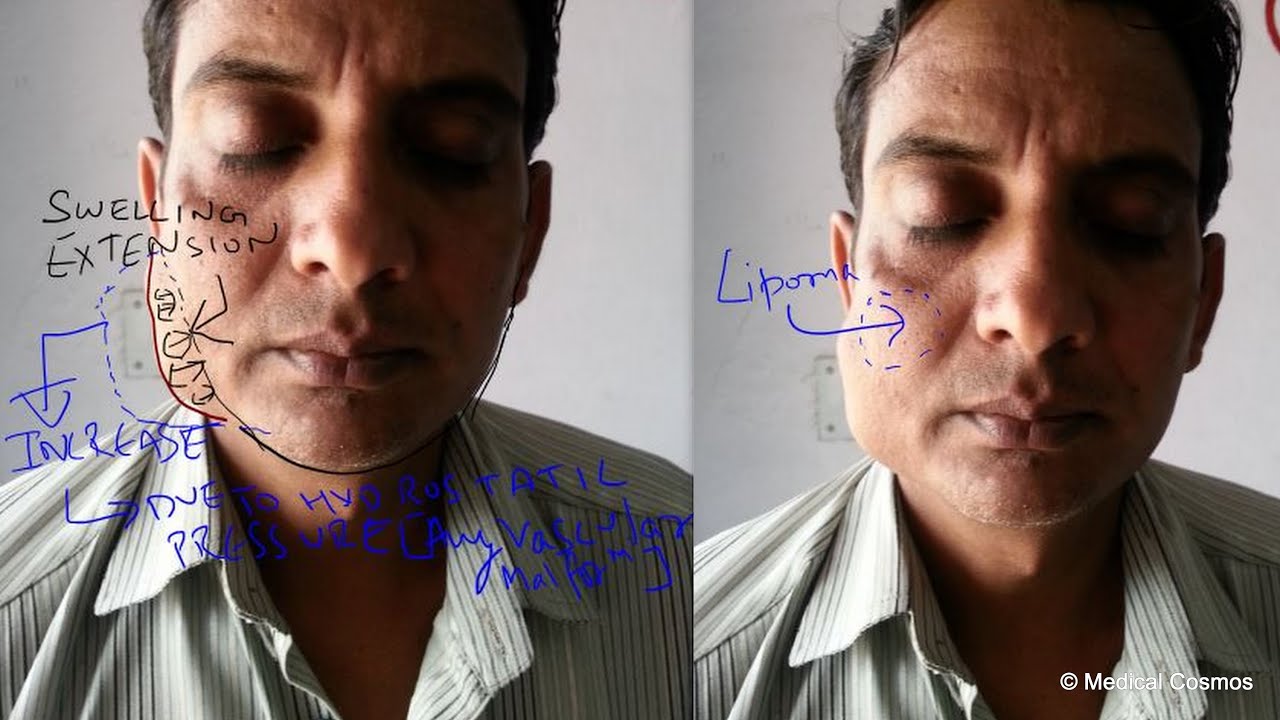 hemangioma-subcutaneous-and-lipoma-right-cheek-youtube