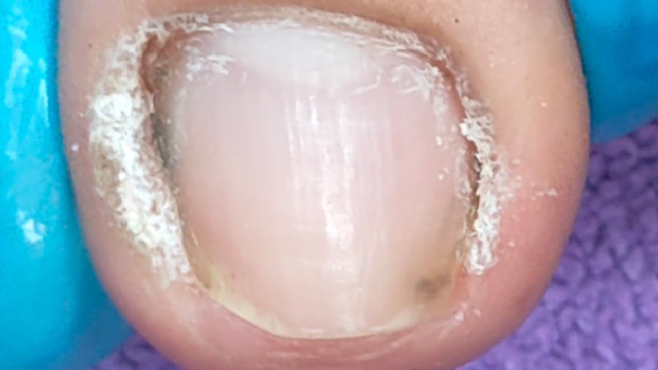 MAKAPAL ANG WARTS O KALUNGGO - YouTube